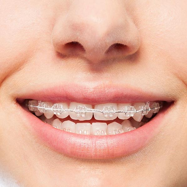 U Ortho SS Tooth Color Wire - Ovoid at Best Price | Dentalkart