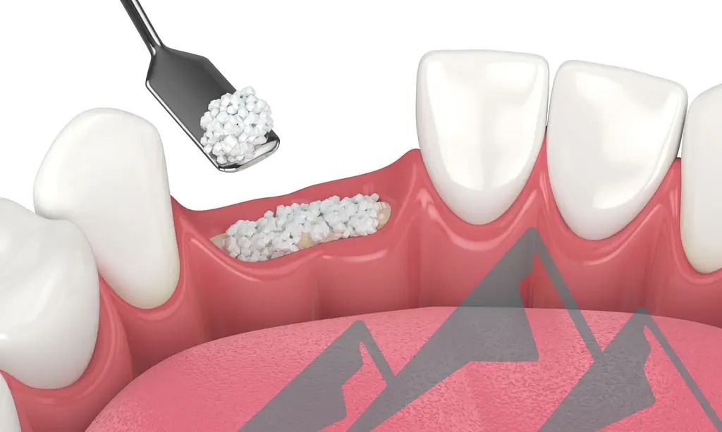 Bone Grafts Online — Xenograft, HA, β-TCP, DBM | Dentalkart